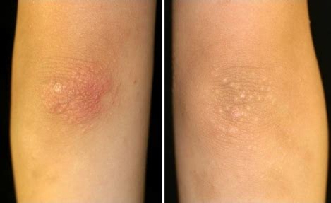Papular Eruption On Both Elbows Open I