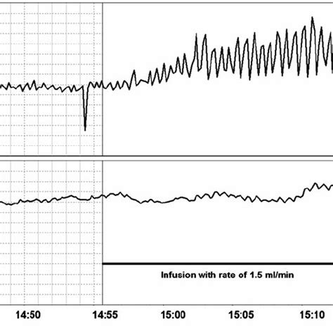 Summary Of Mean Values Of Icp Abp Cpp Cpp Abp−icp And All Nirs Download Table
