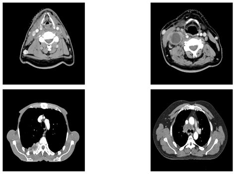 a quantitative comparison between shannon and tsallis havrda charvat entropies applied to cancer