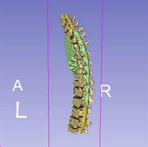 Extramedullary Multiple Myeloma R Radiology