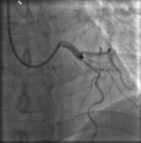 Proximal Lad Stenosis Involving Bifurcation With First Diagonal Branch Download Scientific