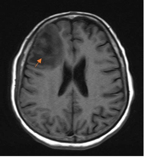 Tumefactive Demyelinating With Open Ring Sign Eurorad