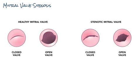 Mitral Valve Stenosis Scai Seconds Count