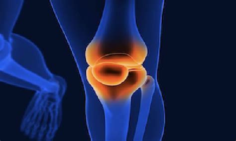 Lipodermatosclerosis Artofit