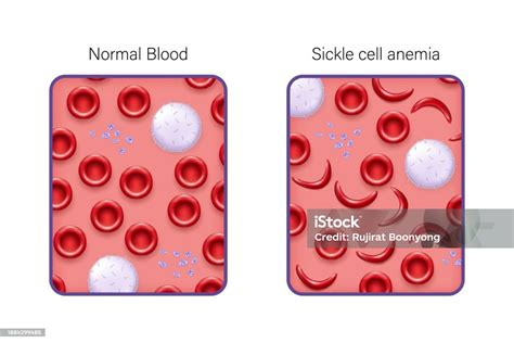 겸상 적혈구 질환 벡터 정상 적혈구와 겸상 적혈구 빈혈의 차이 적혈구 백혈구 및 혈소판 겸상적혈구빈혈증에 대한 스톡 벡터 아트 및 기타 이미지 Istock