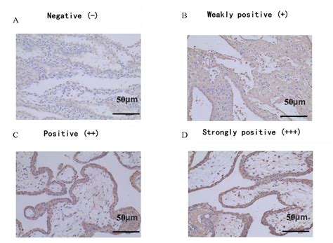 Expression And Correlation Of Complement C And C In Serum And Maternal Fetal Interface In