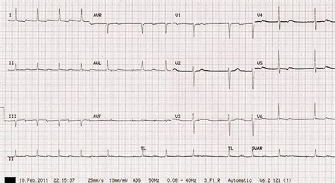 Pacemaker Basics Rebel Em Emergency Medicine Blog