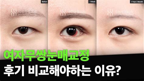 여자무쌍눈매교정 후기를 비교해야 하는 이유 Youtube