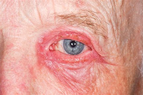 Blepharoconjunctivitis Stock Image C0426386 Science Photo Library
