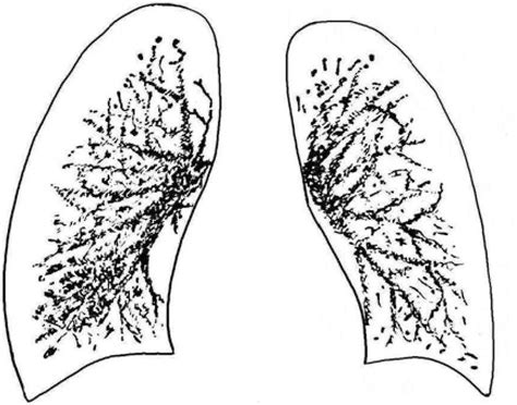 热带嗜酸粒细胞增多症 临床x线鉴别诊断学