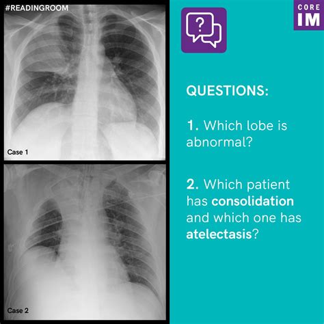 1 Does Lung Pathology Give You Confidence Atelectasis Join Us In The