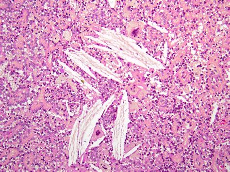 Pathology Outlines Solid Pseudopapillary Neoplasm