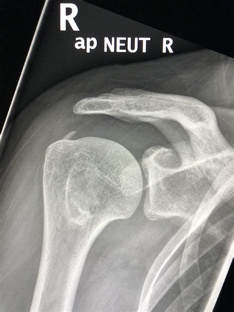 External Rotation Shoulder Xray