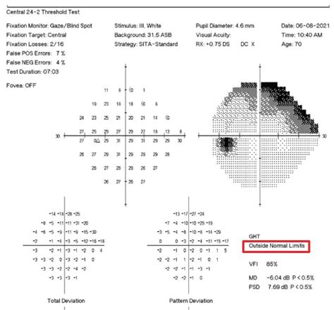 An Update On Standard Automated Perimetry Glaucoma Today