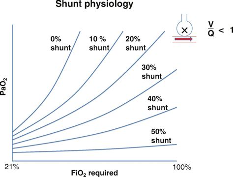 Hypoxia Anesthesia Key