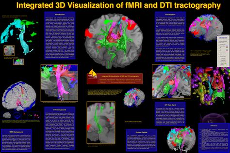 Corticospinal Tract Dti