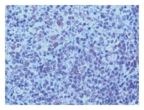 Immunohistochemical Staining Of Lymph Node Biopsy A Cd68 Expression