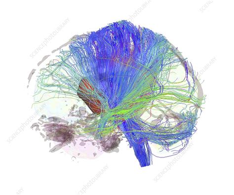 Brain Tumour Dti Mri Scan Stock Image C017 7058 Science Photo Library