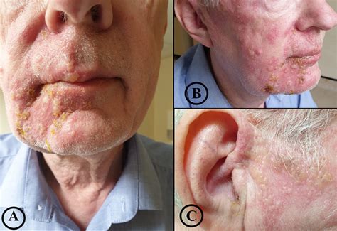 Herpes Zoster Oticus Ramsay Hunt Syndrome