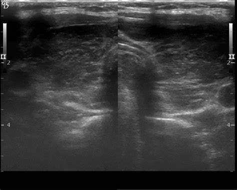 Hashimotos Thyroiditis Ultrasound