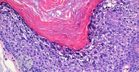 Epidermolytic Hyperkeratosis Pathology Image