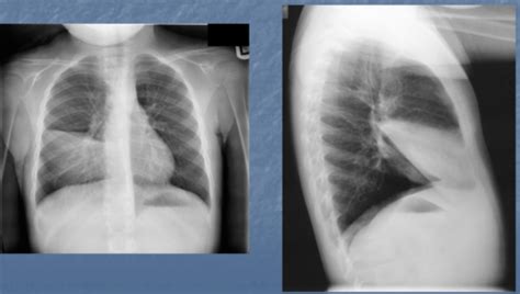 Pa Test Cxr Flashcards Quizlet