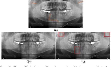 Figure 20 From Automatic Detection Of Mandibular Fractures In Panoramic