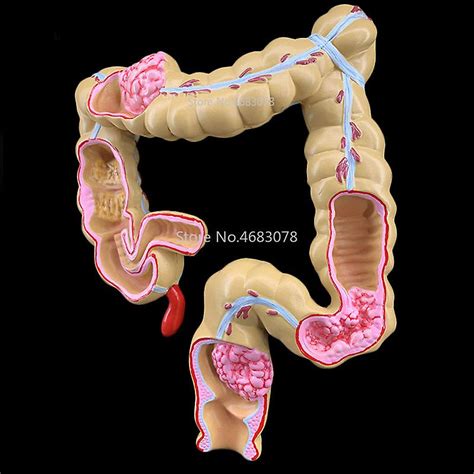 Colorectal Lesion Model Human Colon Large Intestine Pathological Diseases Model Medical