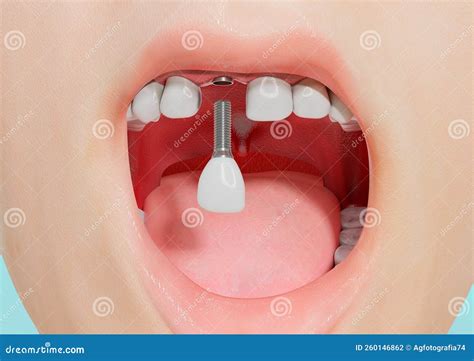 Human Incisor Tooth Implant Dental Crown With Stock Illustration Illustration Of Closeup