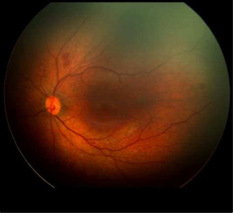 Retinal And Optic Nerve Hemorrhages In The Newborn Infant One Year