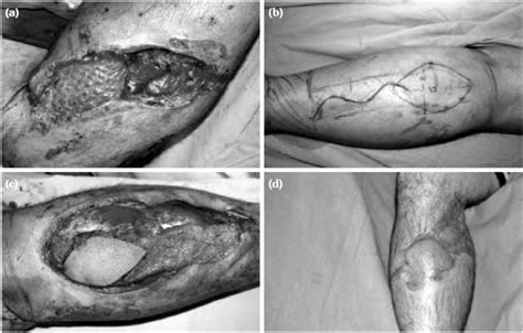 A Year Old Male Suffered A Work Accident Exposed Tibia Has Been Download Scientific