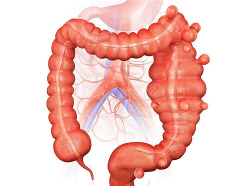 Doença Diverticular Do Cólon Tem Cura Nazaedu