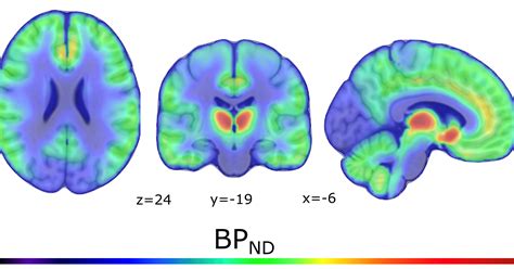 Neuroimaging study reveals brain opioid release during sex Åbo Akademi University