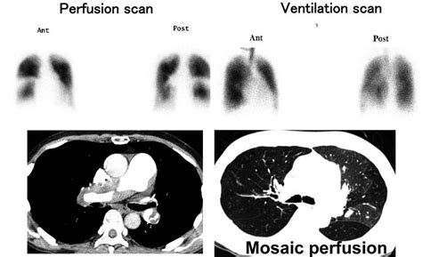 Ventilation Perfusion Scan And CT Angiograms In CTEPH Download Scientific Diagram