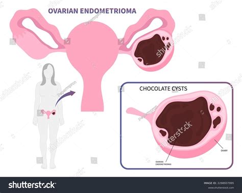 Endometrioma A Transverse Transvaginal Image Of My Xxx Hot Girl