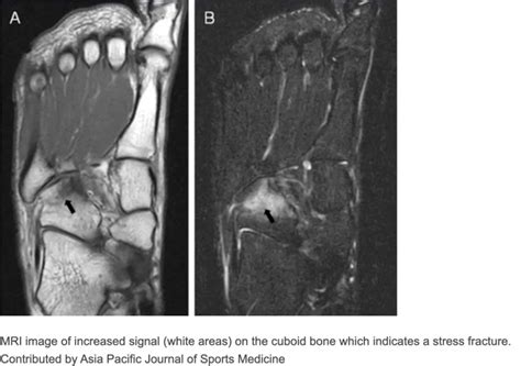 Cuboid Stress Fractures Sports Medicine Review
