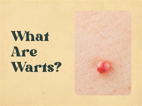 What Are Warts World Hiv Day