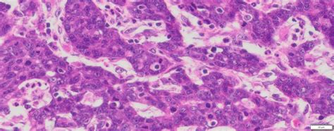 Human Esophageal Cancer Ffpe Sections