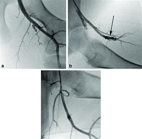 Scoring System For Arteriographic Follow Up A Complete Occlusion Download Scientific