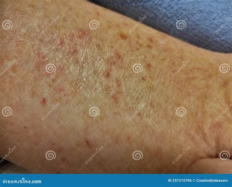 Subunguale Splinter Hemorragie Veroorzaakt Door Subacute Bacteriële