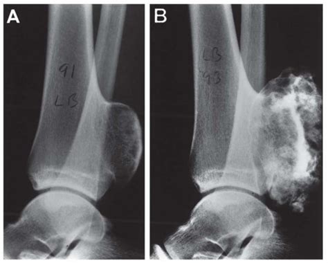 Chondrosarcoma Primary Secondary Dedifferentiated And Clear Cell Musculoskeletal Key