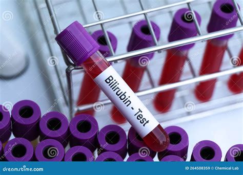 Bilirubin Test To Look For Abnormalities From Blood Stock Image Image Of Health Clinic 264508359
