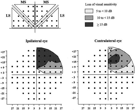 Inferior Temporal Visual Field Defect Interpreting Visual Fields