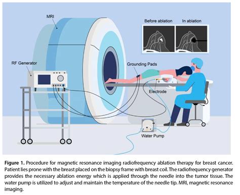 Magnetic Resonance Imaging Guided Radiofrequency Ablation Of Breast Cancer A Current State Of