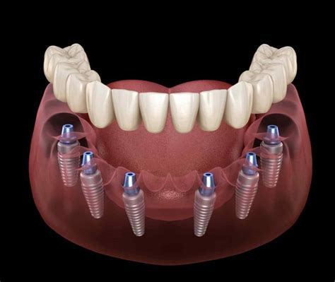 Dental Implants Turkey Cost The More Clinics Best Choice