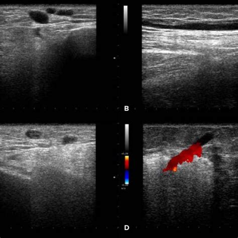 Pdf Severity Stratification By Compression Ultrasound Examination In