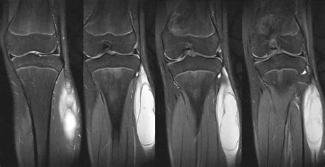 Ganglion Cyst Proximal Tibiofibular Articulation
