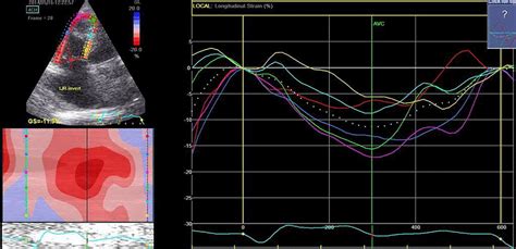 RV Regional Longitudinal Strain Curves In An SSc Patient With PAH Download Scientific Diagram