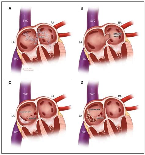 World Stroke Academy On Linkedin Mondaytip Pfo Pascal Rope