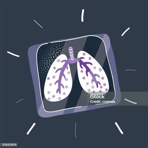 어두운 배경에 의학적 진단을 위해 인간의 가슴의 X 선 샷의 벡터 그림 폐암에 대한 스톡 벡터 아트 및 기타 이미지 폐암 건강 진단 벡터 Istock